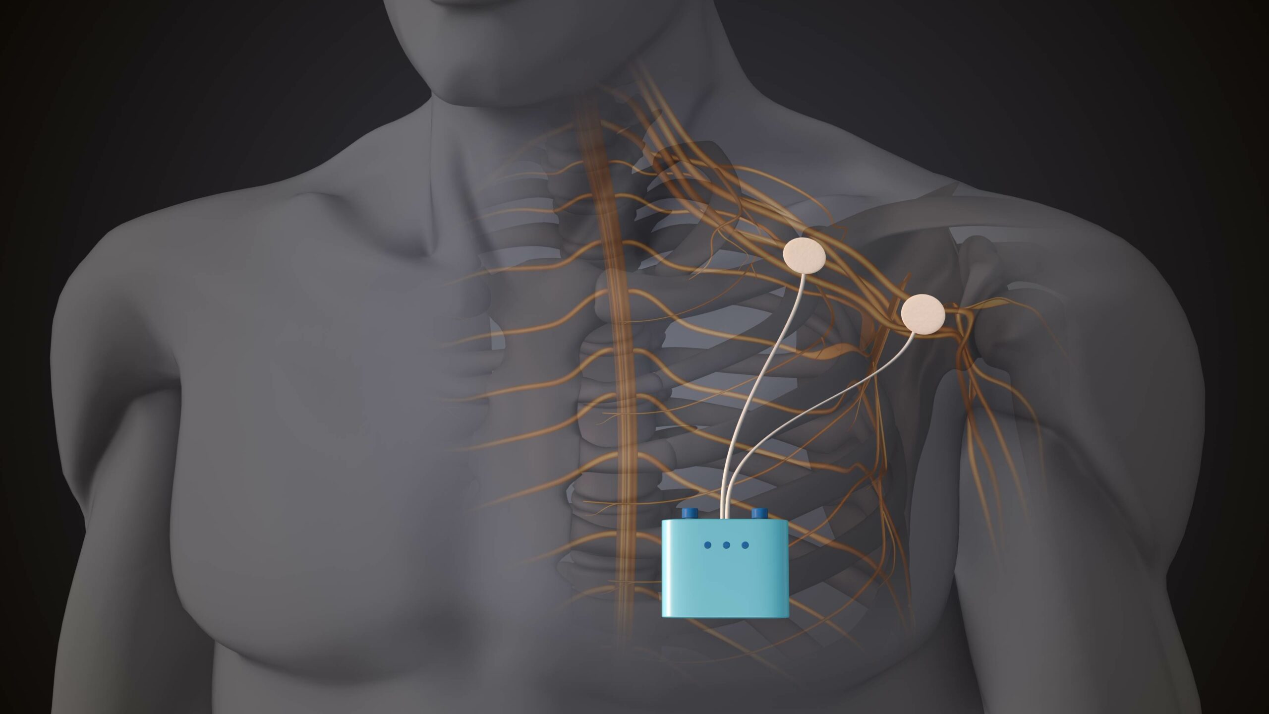 Peripheral Nerve Block Eclipse Clinic