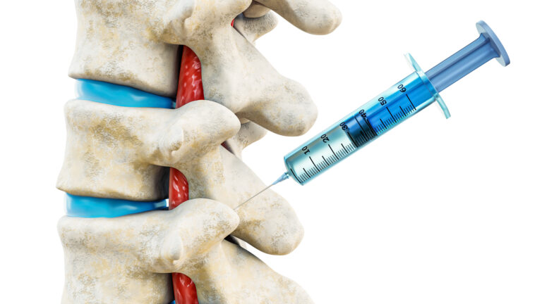 Facet Injections & Rhizotomy | Relief for Facet Joint Pain